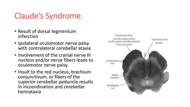 Mid brain anatomy and vascular syndromes | PPTX | Brain and Nervous ...