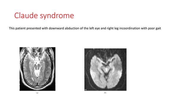 Mid brain anatomy and vascular syndromes | PPTX | Brain and Nervous ...