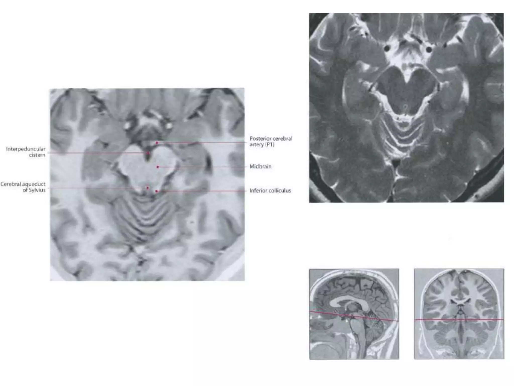 Midbrain-Neuroradiology | PPTX
