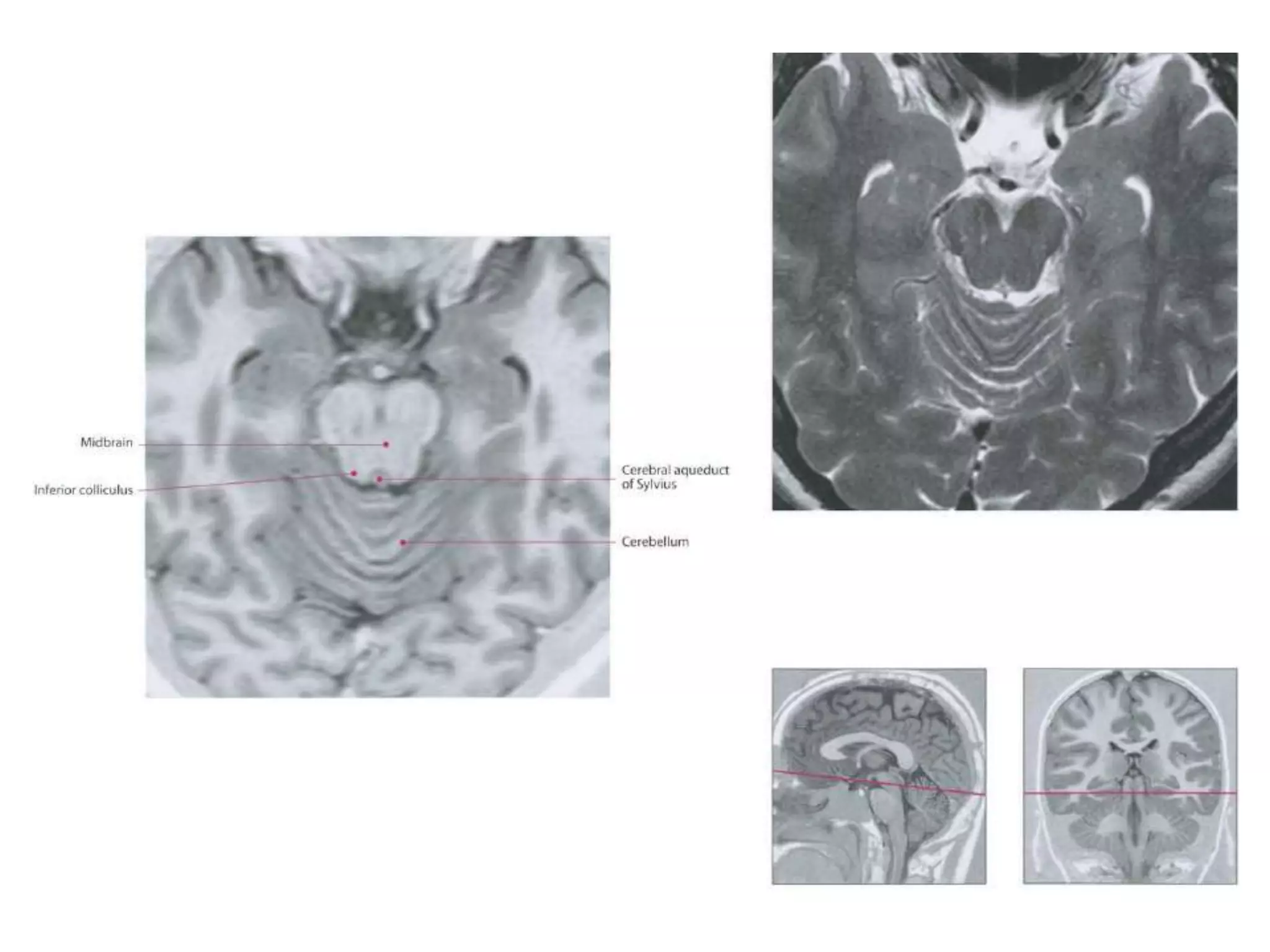 Midbrain-Neuroradiology | PPTX
