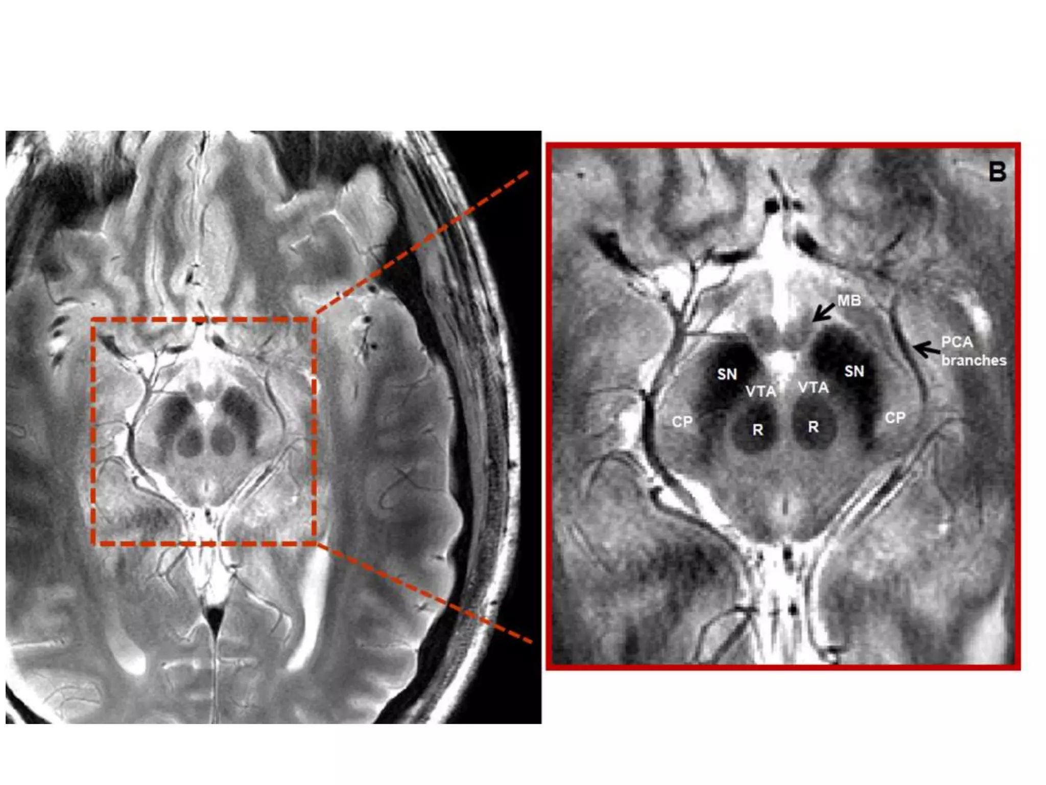 Midbrain-Neuroradiology | PPTX