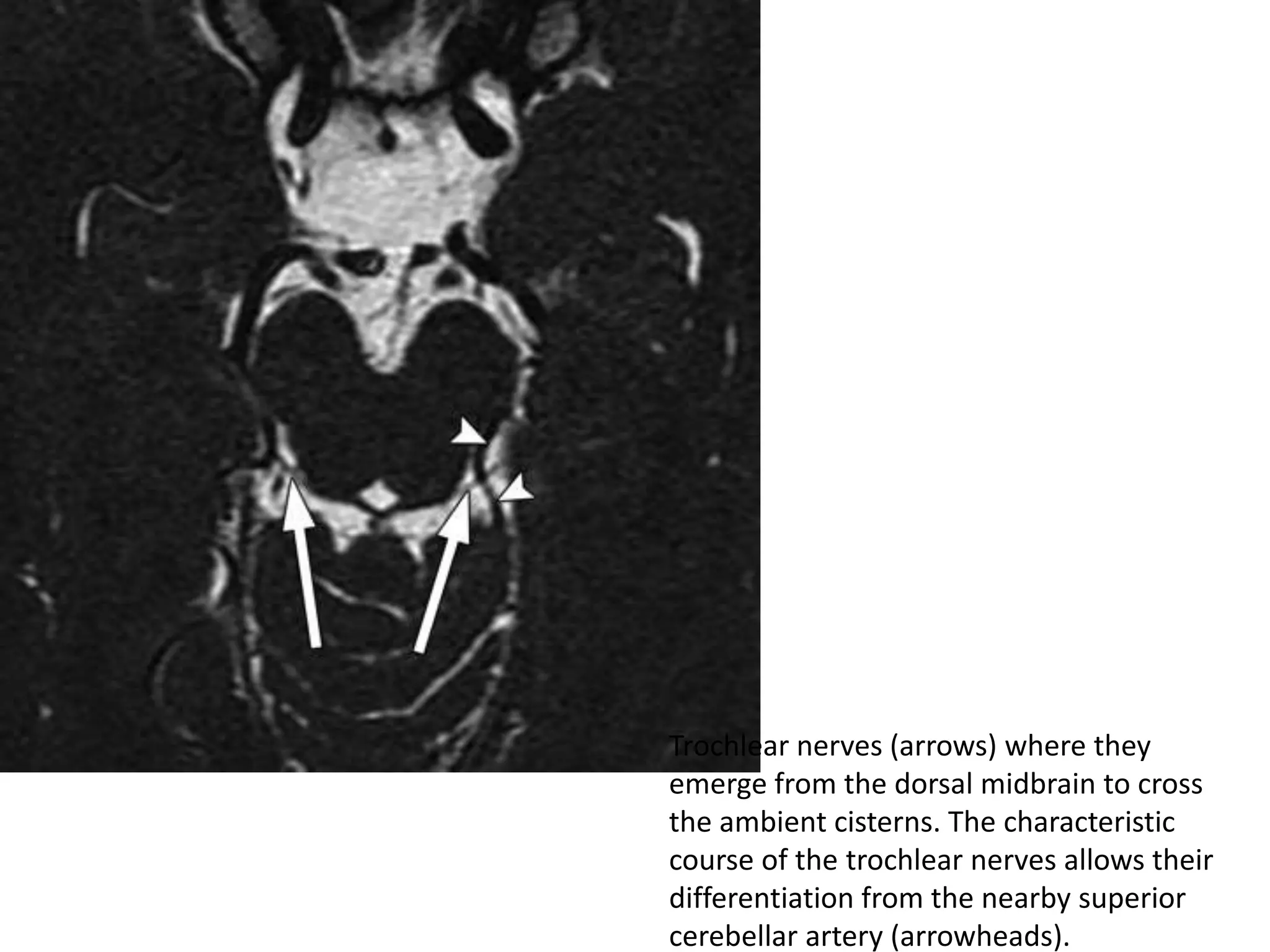 Midbrain-Neuroradiology | PPTX