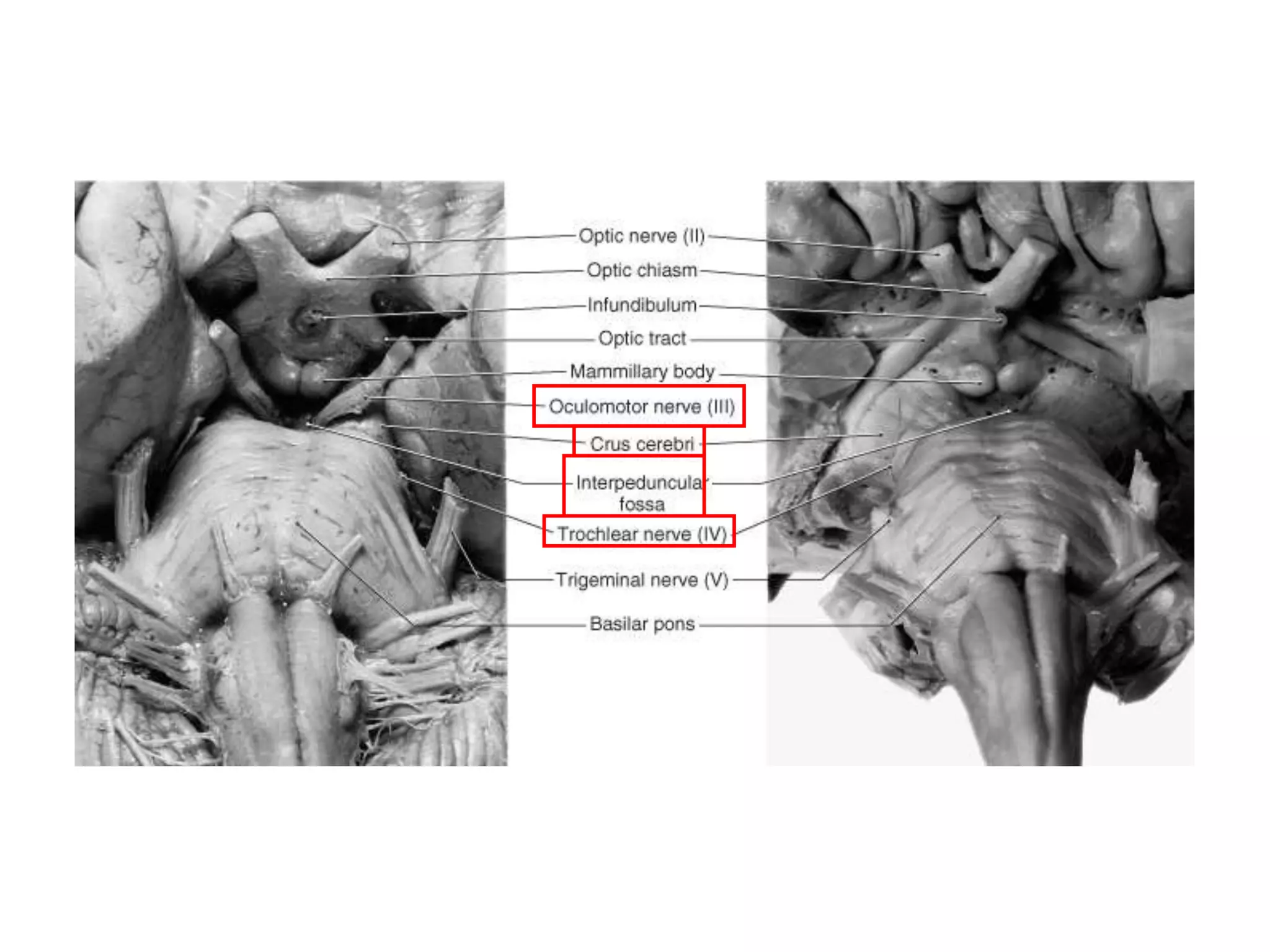 Midbrain-Neuroradiology | PPTX