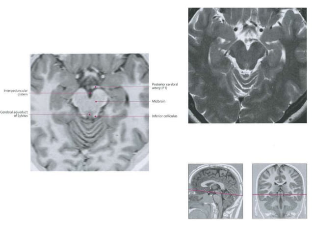 Midbrain-Neuroradiology | PPTX