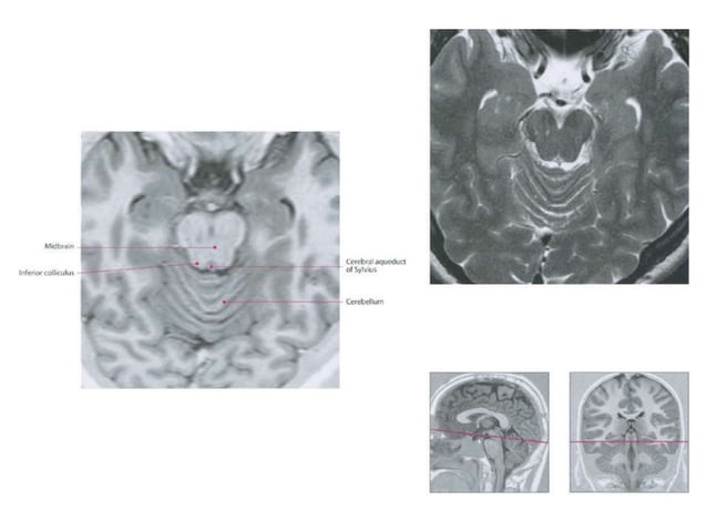 Midbrain-Neuroradiology | PPTX