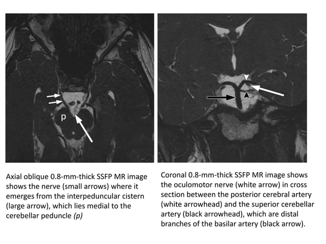 Midbrain-Neuroradiology | PPTX