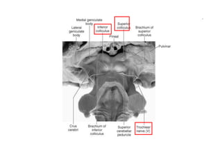 Midbrain-Neuroradiology | PPTX