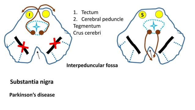 Anatomy of Midbrain and pons | PDF | Death, Injury, or Military ...