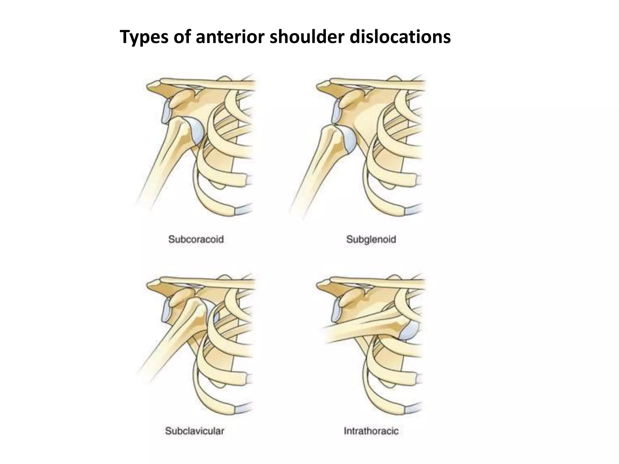 Management of Shoulder dislocations and shoulder instability in sports ...
