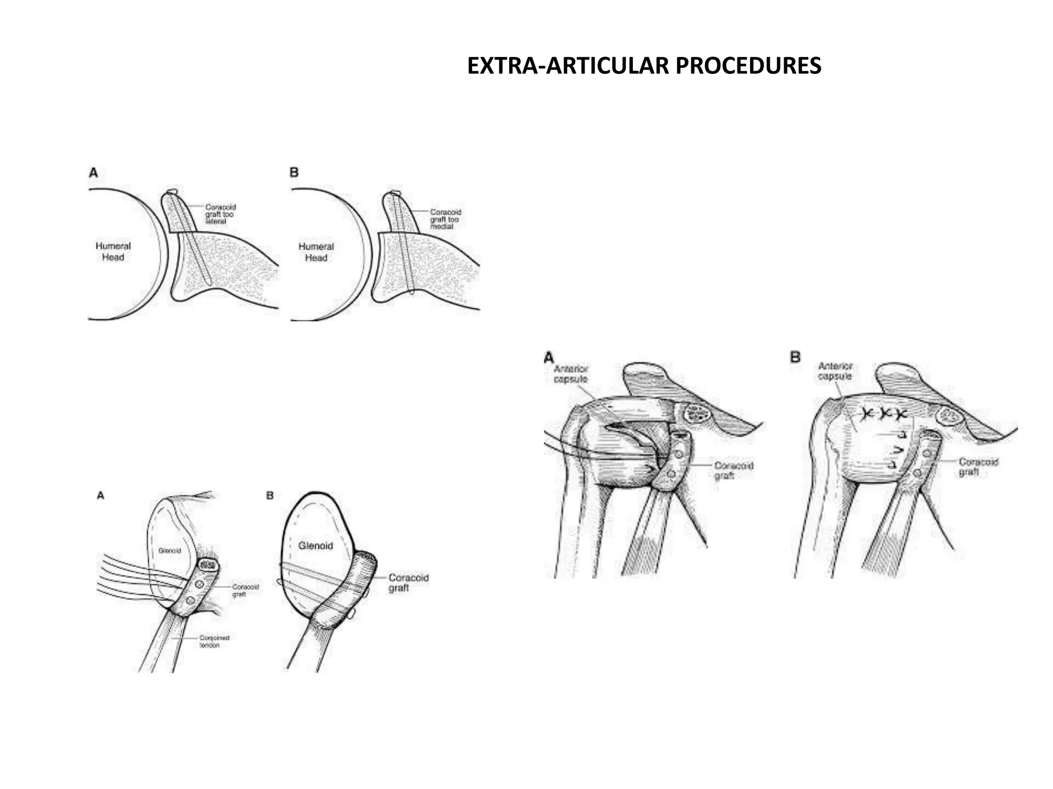 Management of Shoulder dislocations and shoulder instability in sports ...