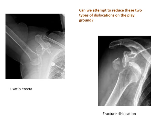 Management of Shoulder dislocations and shoulder instability in sports ...