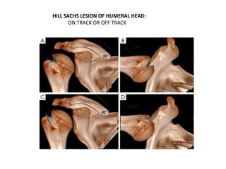 Management of Shoulder dislocations and shoulder instability in sports ...