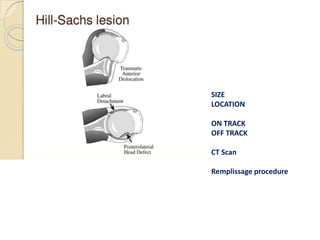 Management of Shoulder dislocations and shoulder instability in sports ...
