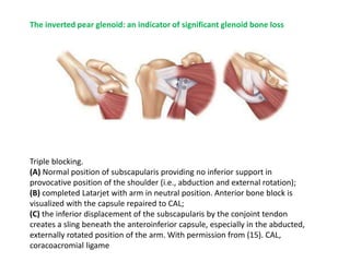 Management of Shoulder dislocations and shoulder instability in sports ...