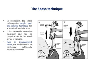 Management of Shoulder dislocations and shoulder instability in sports ...