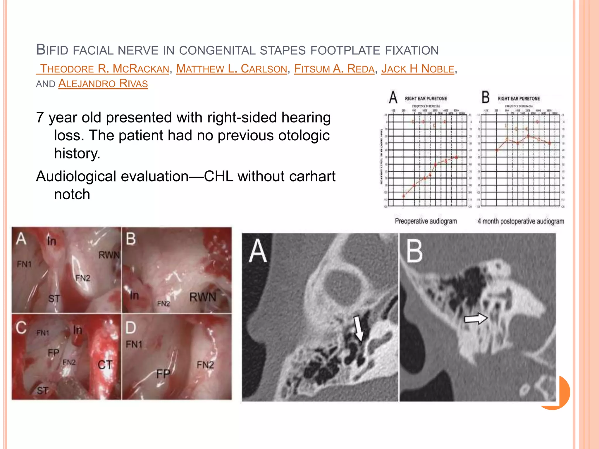 MIDDLE EAR ANOMALIES | PPTX