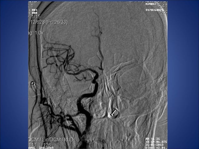 Middle cerebral artery stenting | PPT