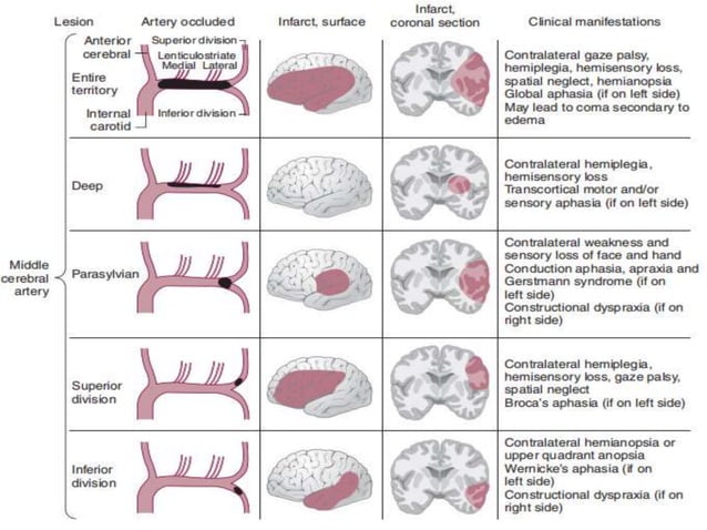 Middle Cerebral Artery Syndromes Ppt