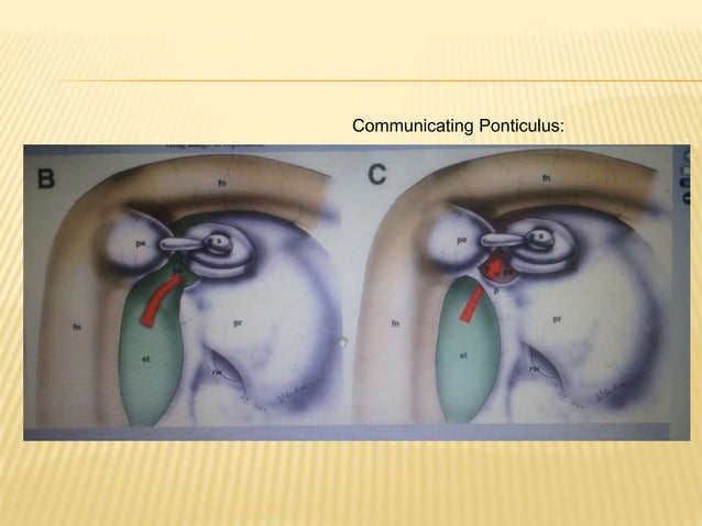 Middle Ear Anatomy - Arjun Antony Graison | PPT