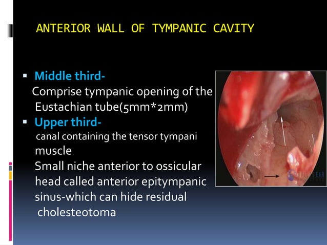 Anatomy Of Middle Ear Cleft | PPTX