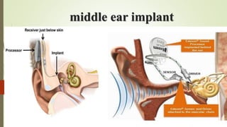 middle ear implant.pptx