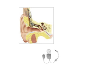 MIDDLE EAR IMPLANT Detailed POWERPOINT PRESENTATION | PPTX