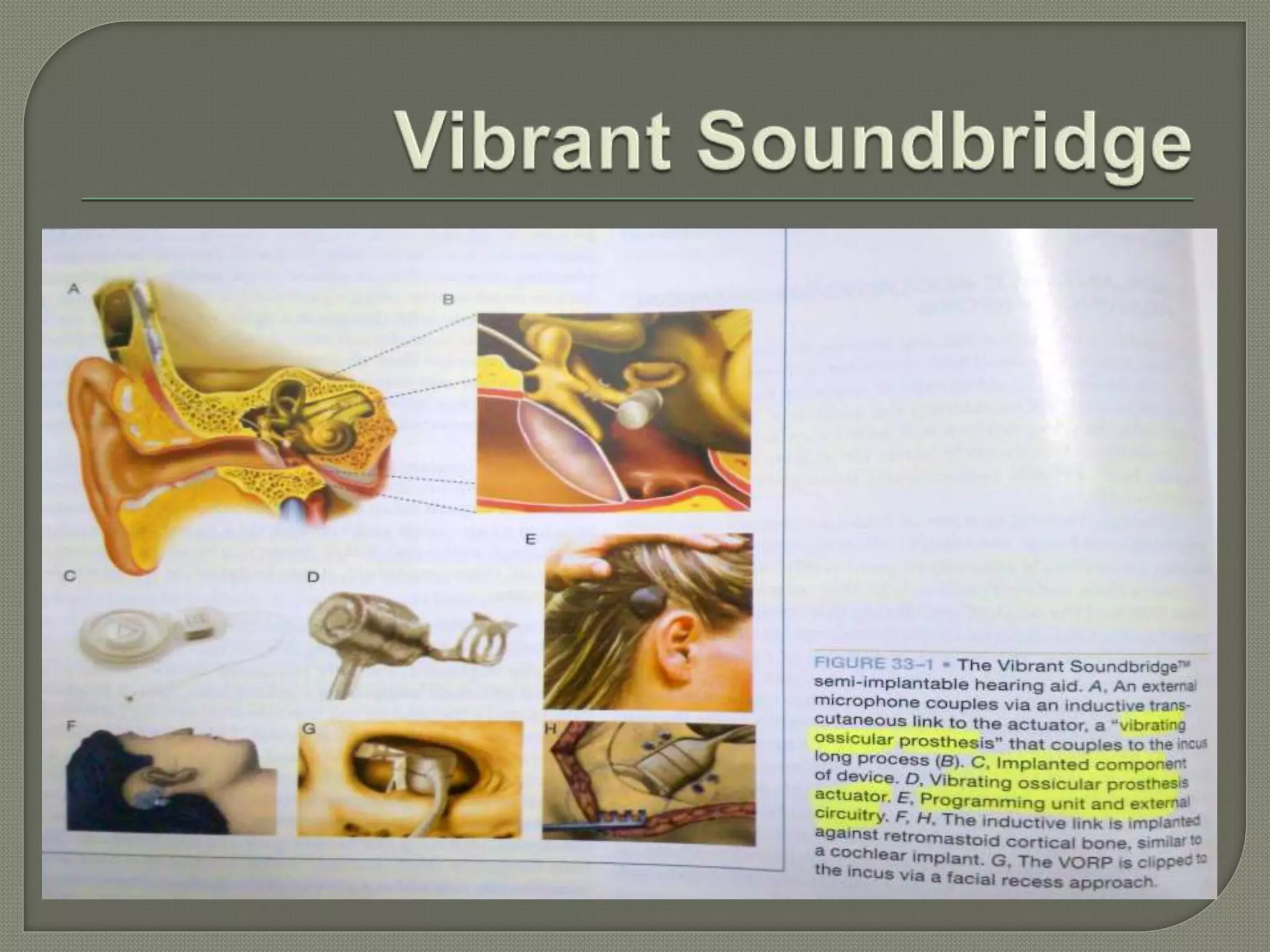 Middle ear implants | PPTX