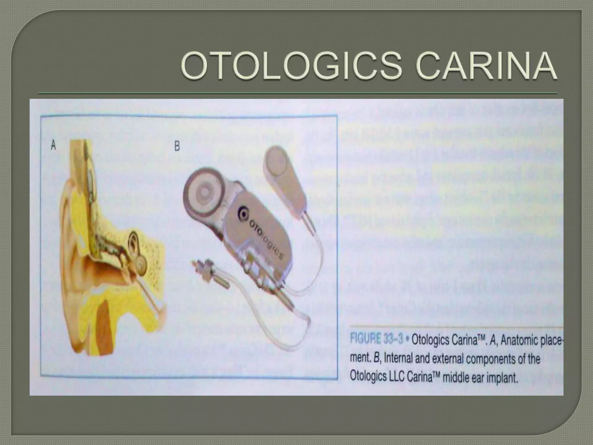 Middle ear implants | PPTX