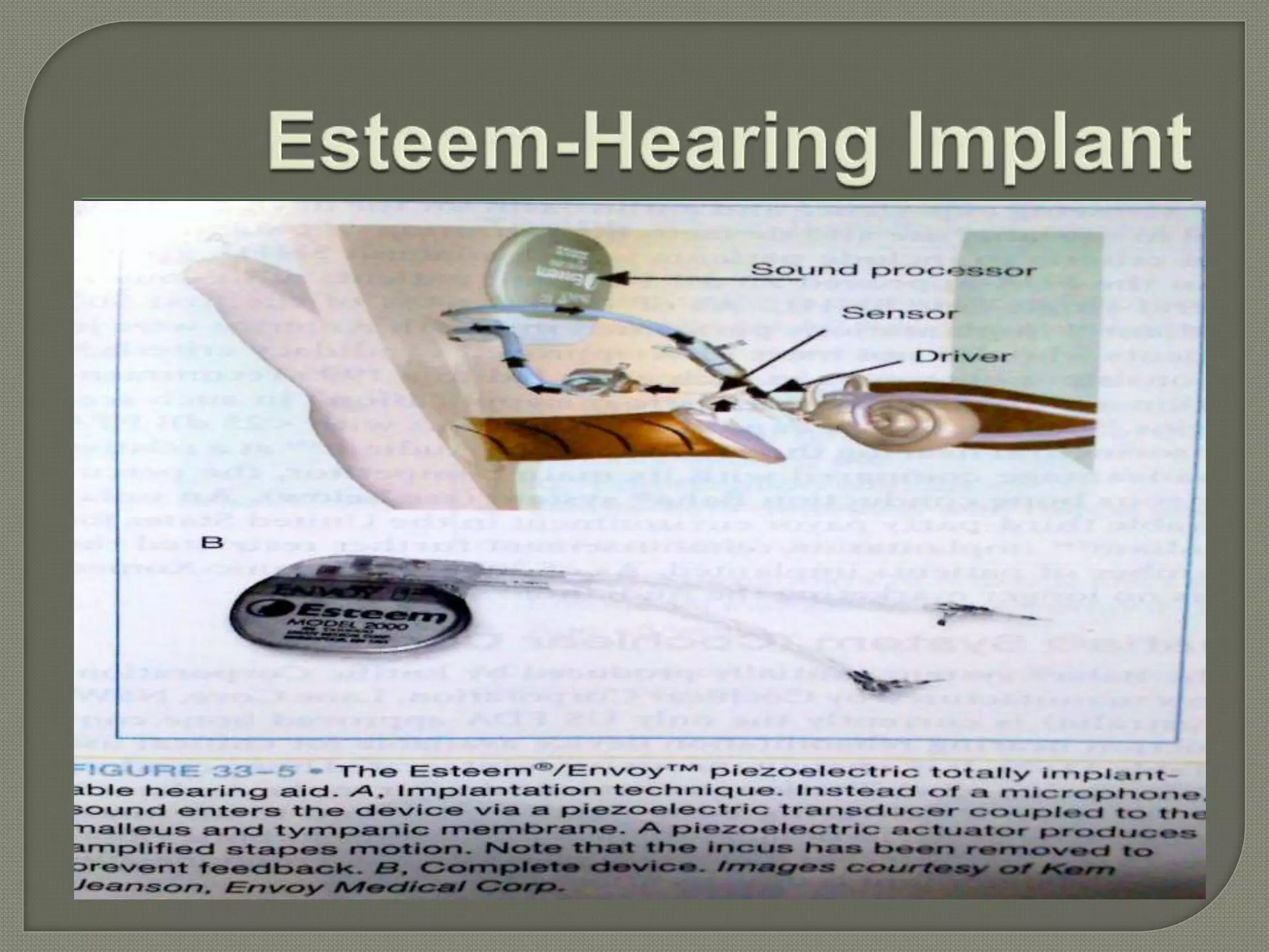 Middle ear implants | PPTX