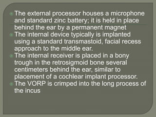 Middle ear implants | PPTX