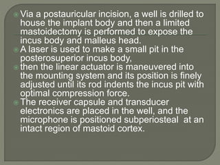 Middle ear implants | PPTX