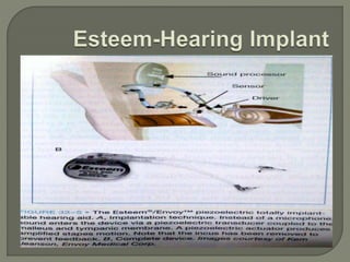 Esteem Cochlear Implant