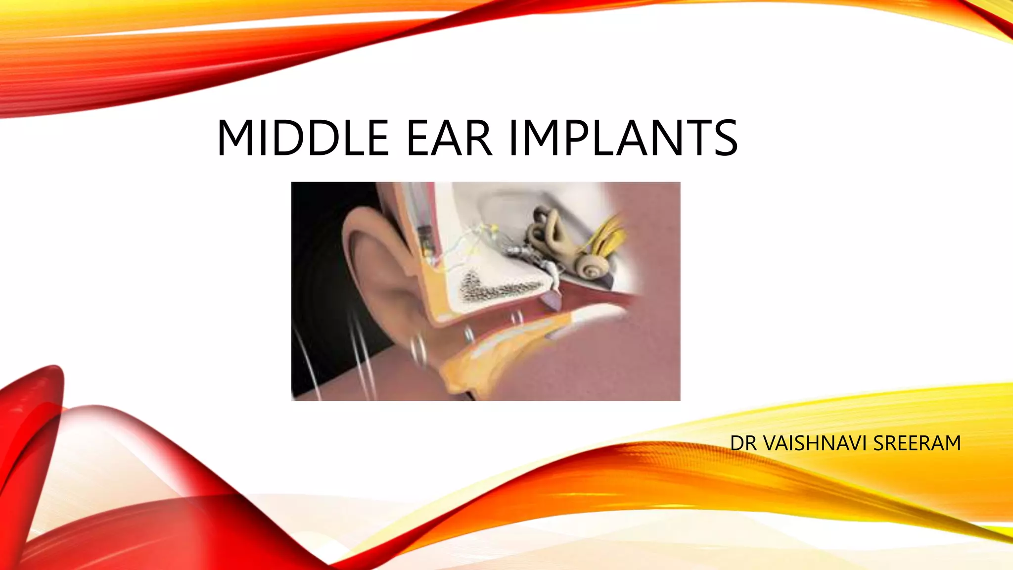 MIDDLE EAR IMPLANTS.pptx