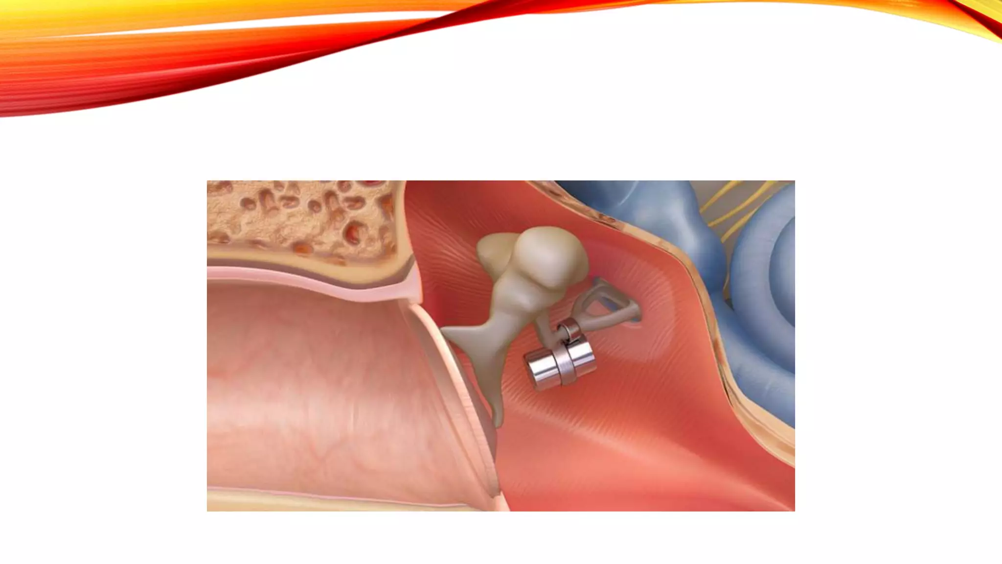 MIDDLE EAR IMPLANTS.pptx