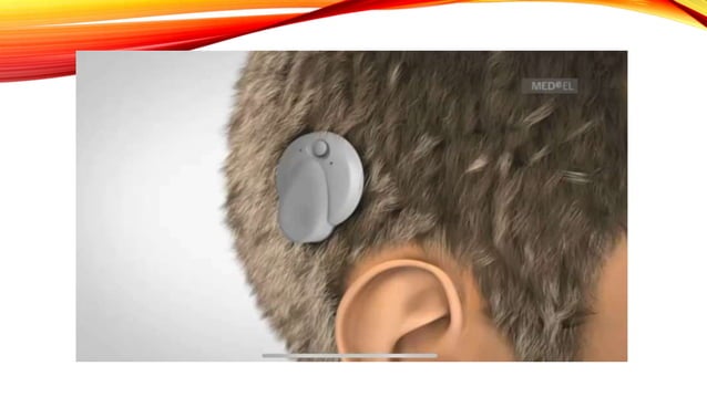 MIDDLE EAR IMPLANTS.pptx