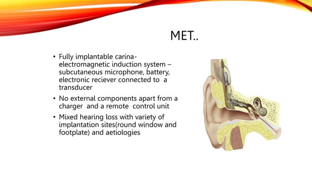 MIDDLE EAR IMPLANTS.pptx