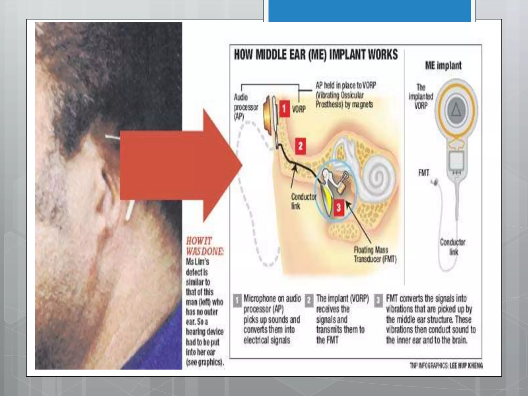 MIDDLE EAR IMPLANTS ppt new.pptx