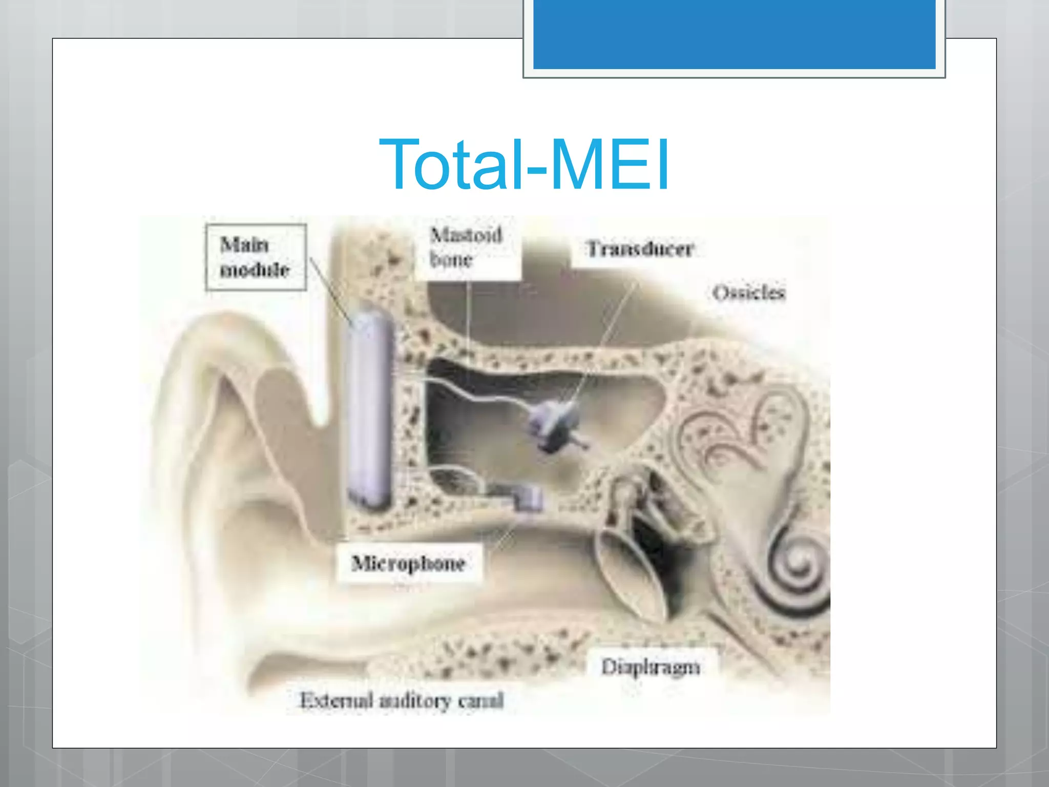 MIDDLE EAR IMPLANTS ppt new.pptx