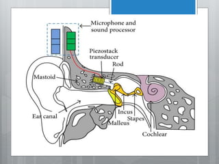 MIDDLE EAR IMPLANTS ppt new.pptx