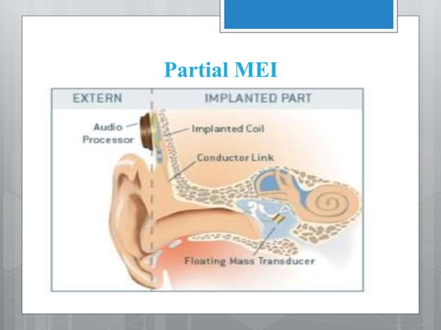 MIDDLE EAR IMPLANTS ppt new.pptx