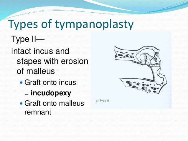 Middle ear reconstruction