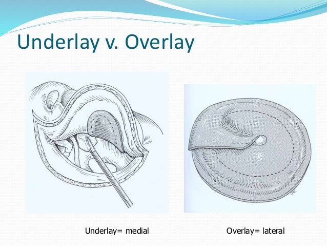 Middle ear reconstruction