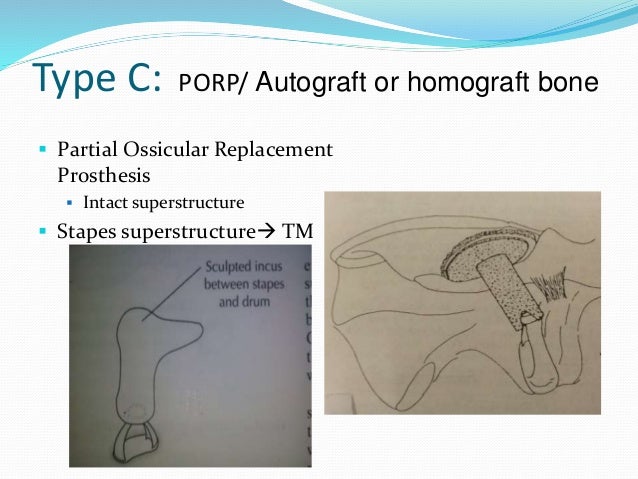 Middle ear reconstruction