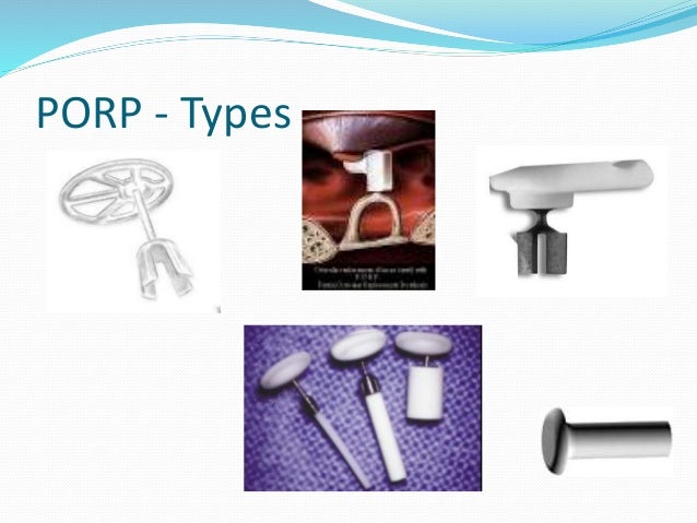 Middle ear reconstruction
