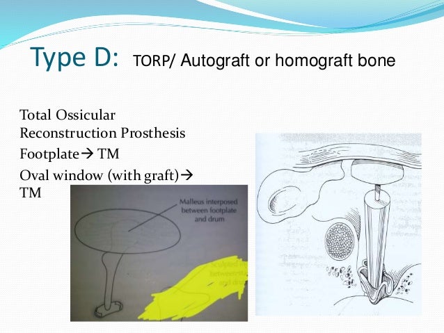 Middle ear reconstruction