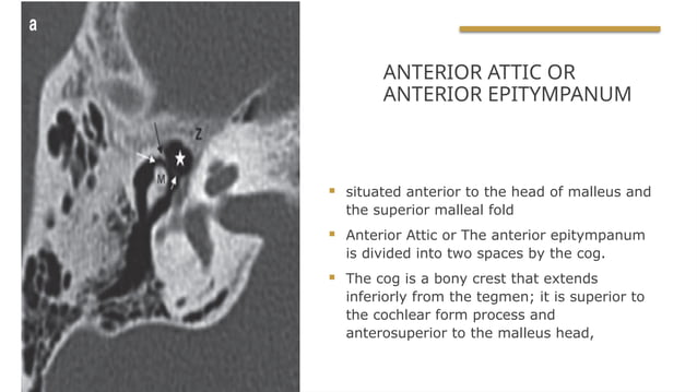 middle ear spaces and mucosal folds Otorhinolaryngology | PPTX | Ear ...