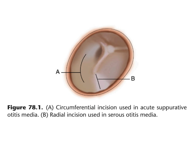 Middle Ear Surgery.pdf