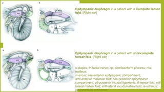 Middle ear ventilatory pathway and Mucosal folds.pptx