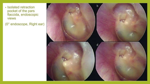 Middle ear ventilatory pathway and Mucosal folds.pptx