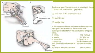 Middle ear ventilatory pathway and Mucosal folds.pptx